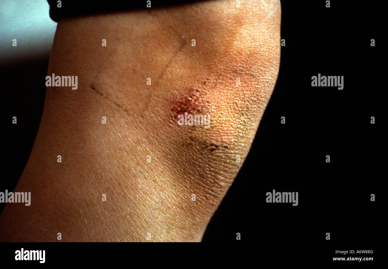 Grazed knee hi-res stock photography and images - Alamy
