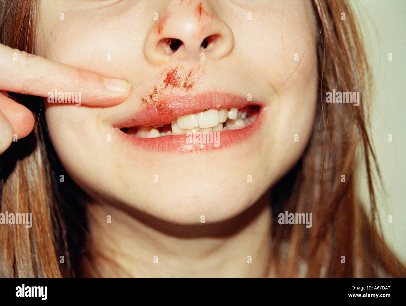 Young girl with a scratched face Stock Photo - Alamy