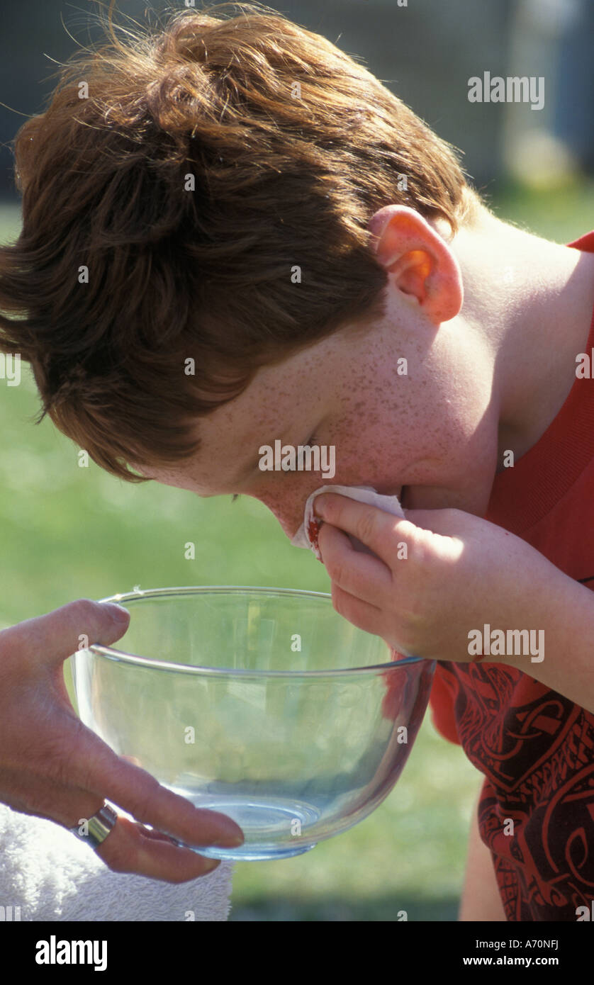 Bleeding Nose Stock Photos & Bleeding Nose Stock Images - Alamy