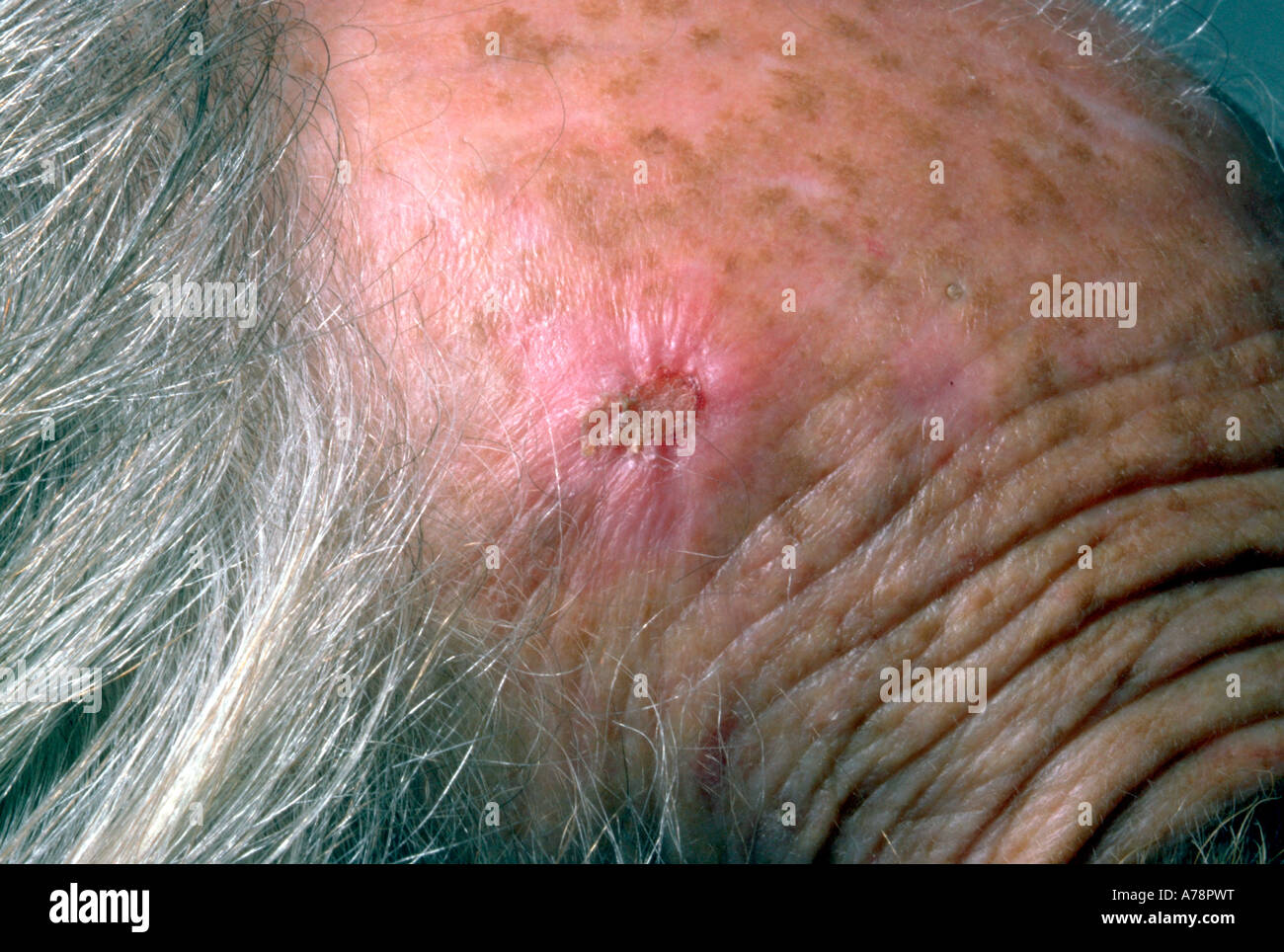 Actinic keratosis hi-res stock photography and images - Alamy