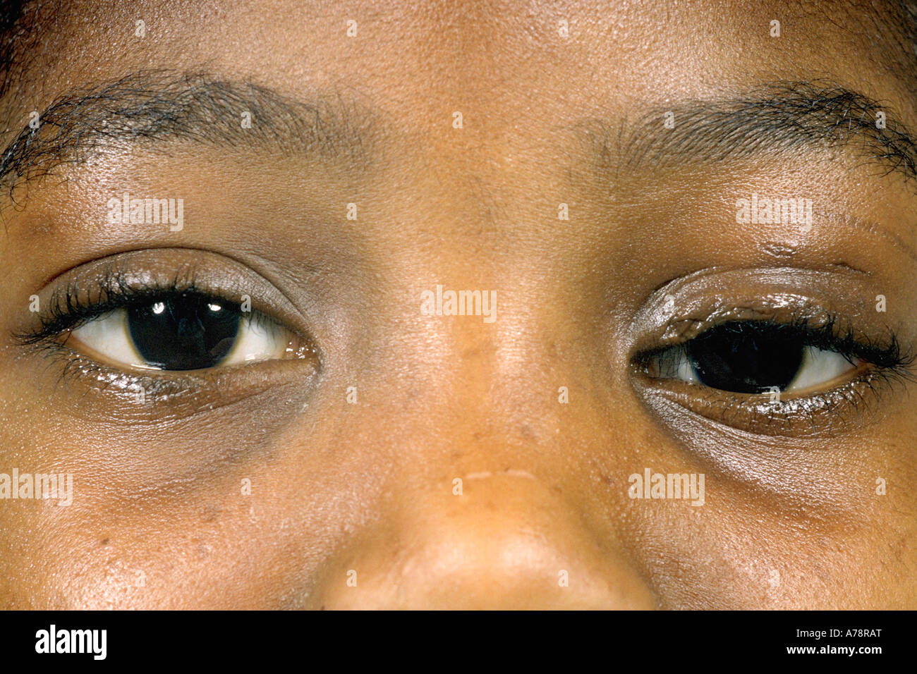 Ptosis hi-res stock photography and images - Alamy