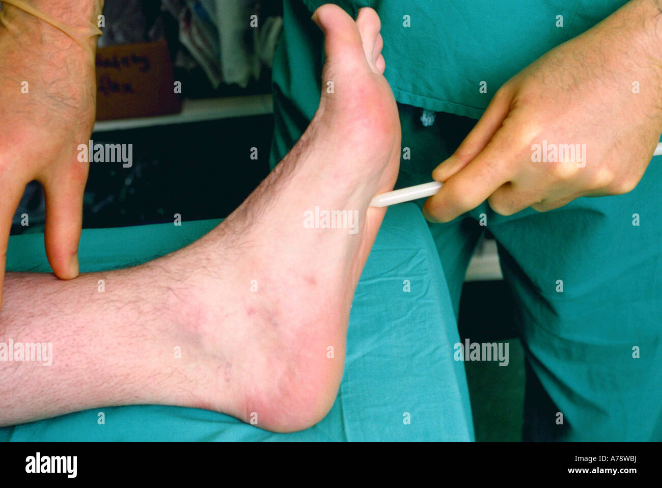 Testing the plantar reflex on sole of foot Stock Photo - Alamy