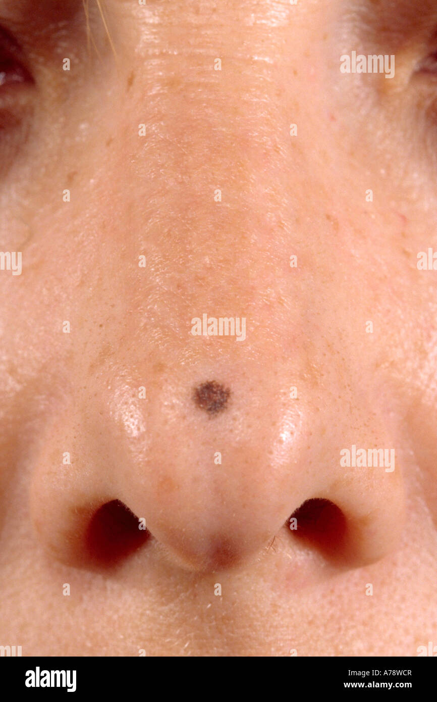 Naevus hi-res stock photography and images - Alamy