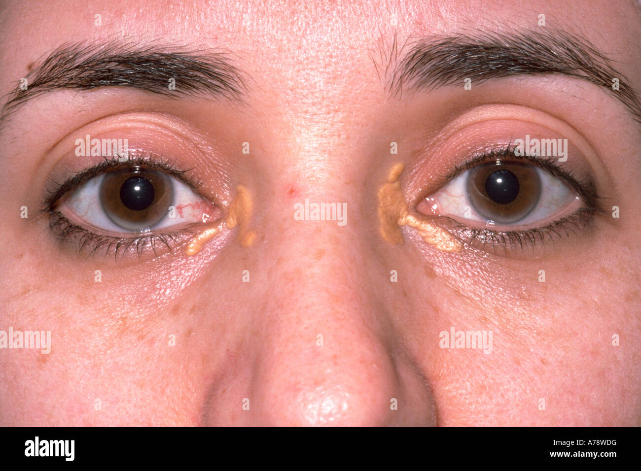 Tendon Xanthoma Hypercholesterolaemia Stock Photo Royalty