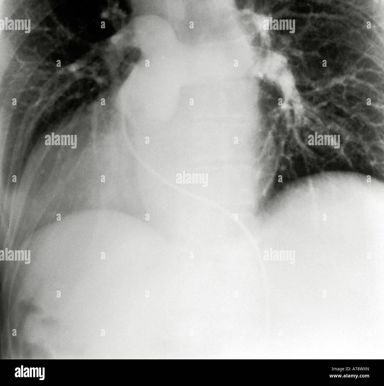 PULMONARY ANGIOGRAM X-RAY - PULMONARY EMBOLISM Stock Photo - Alamy