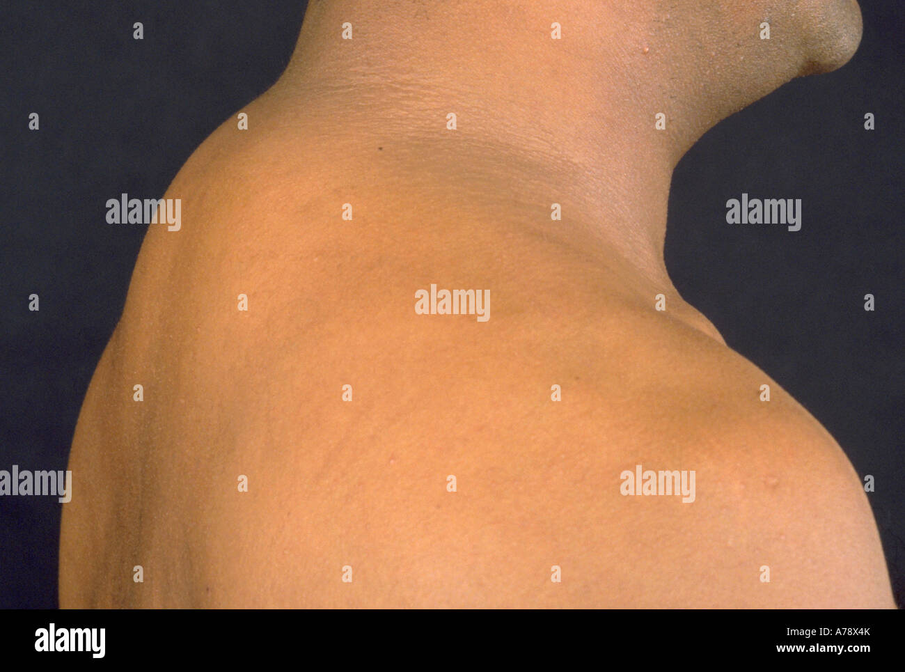 Lipodystrophy syndrome hi-res stock photography and images - Alamy