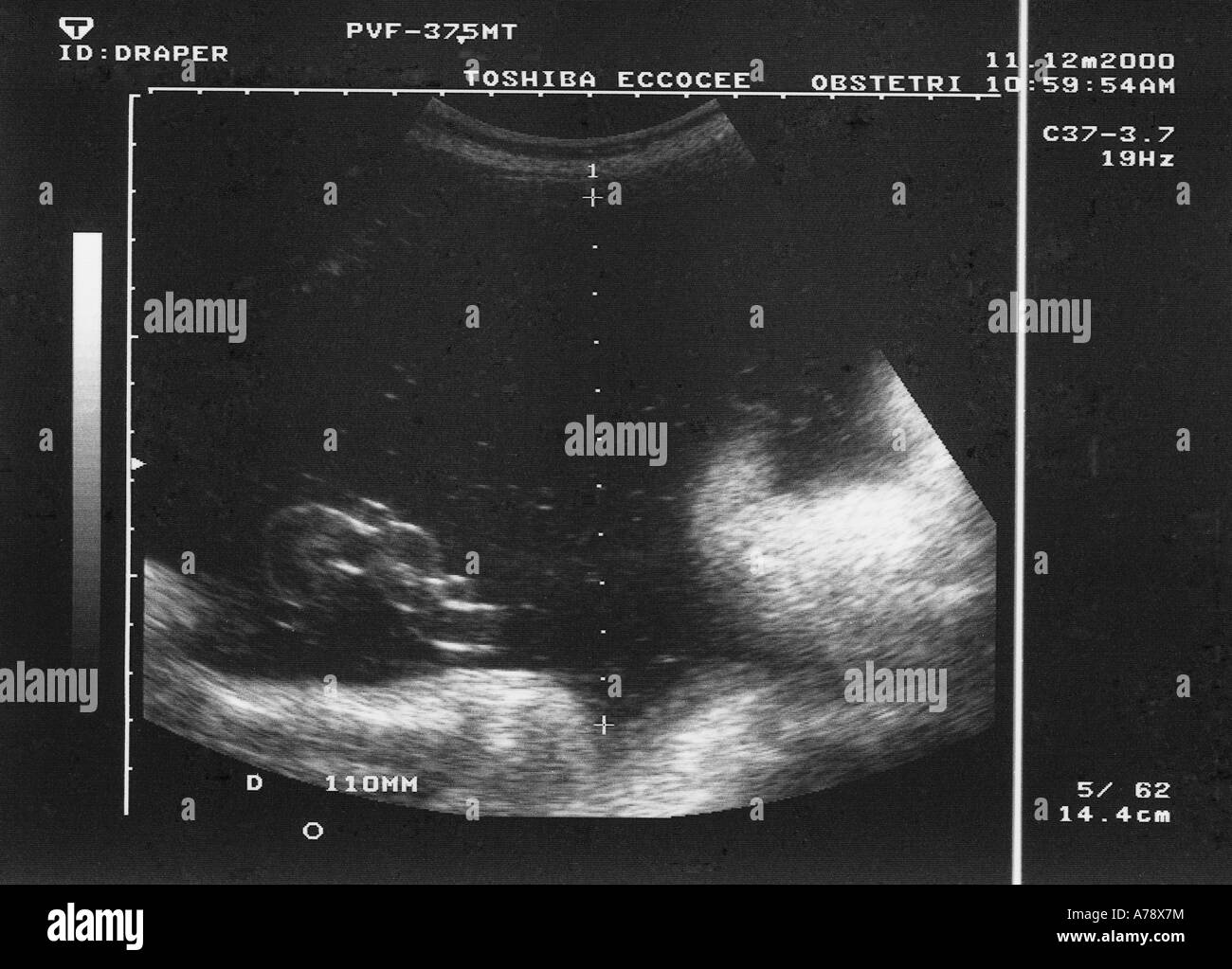 ULTRASOUND SCAN - POLYHYDRAMNIOS Stock Photo - Alamy