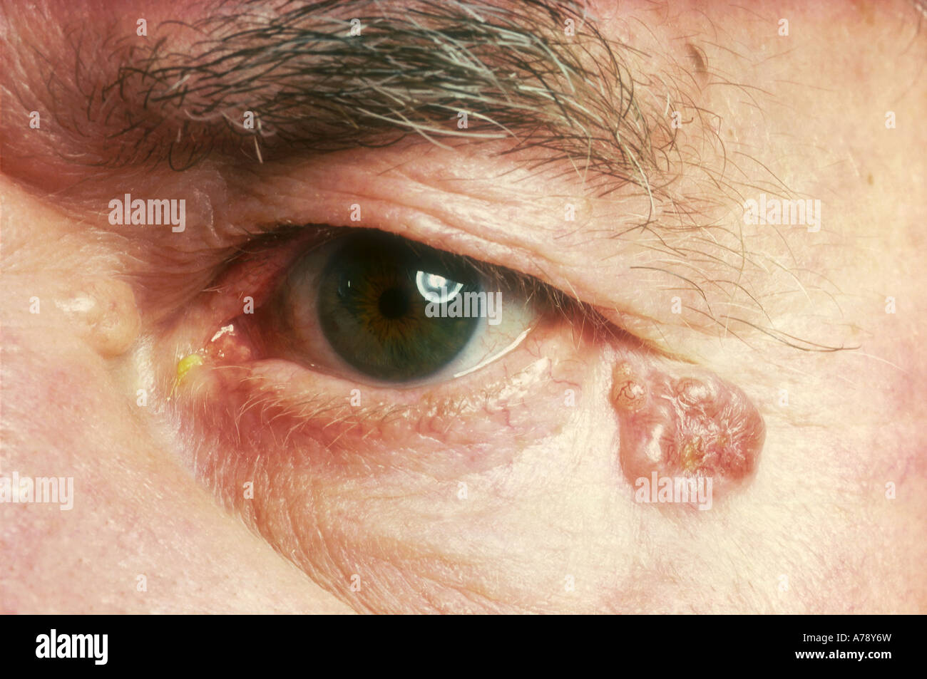 Rodent ulcer hi-res stock photography and images - Alamy