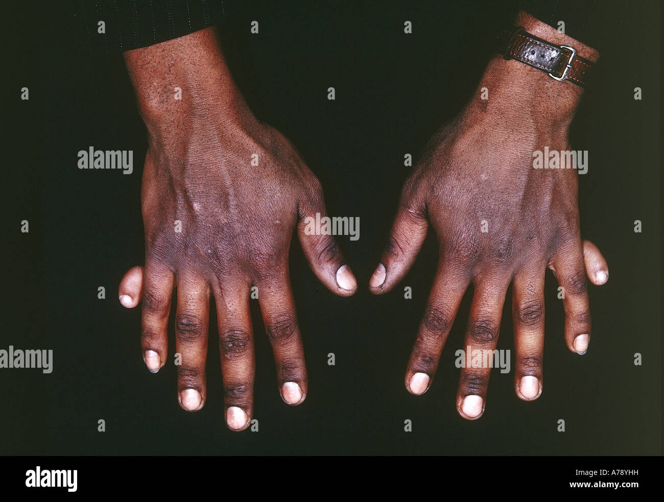 Polydactyly hi-res stock photography and images - Alamy