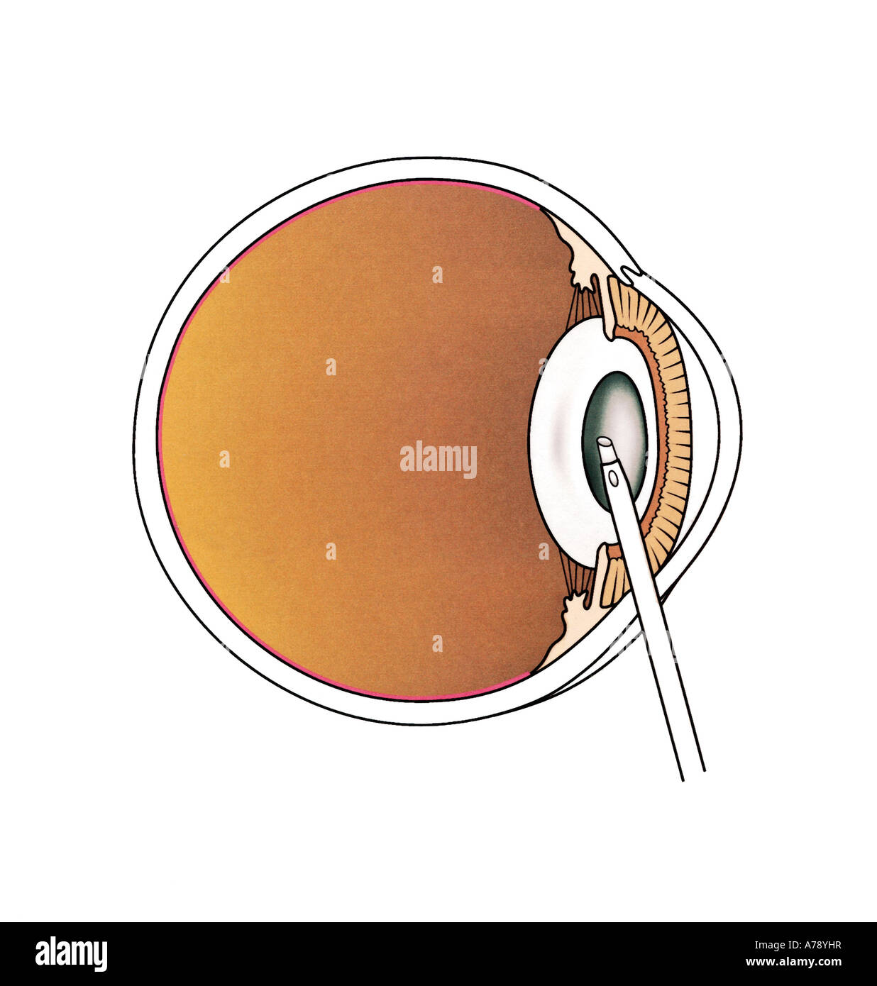 ILLUSTRATION - CATARACT SURGERY Stock Photo - Alamy
