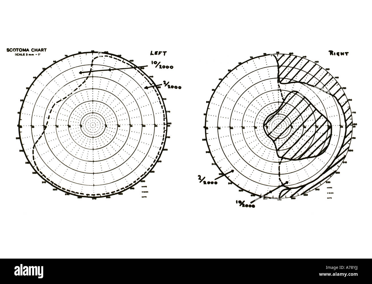 Scotomata hi-res stock photography and images - Alamy