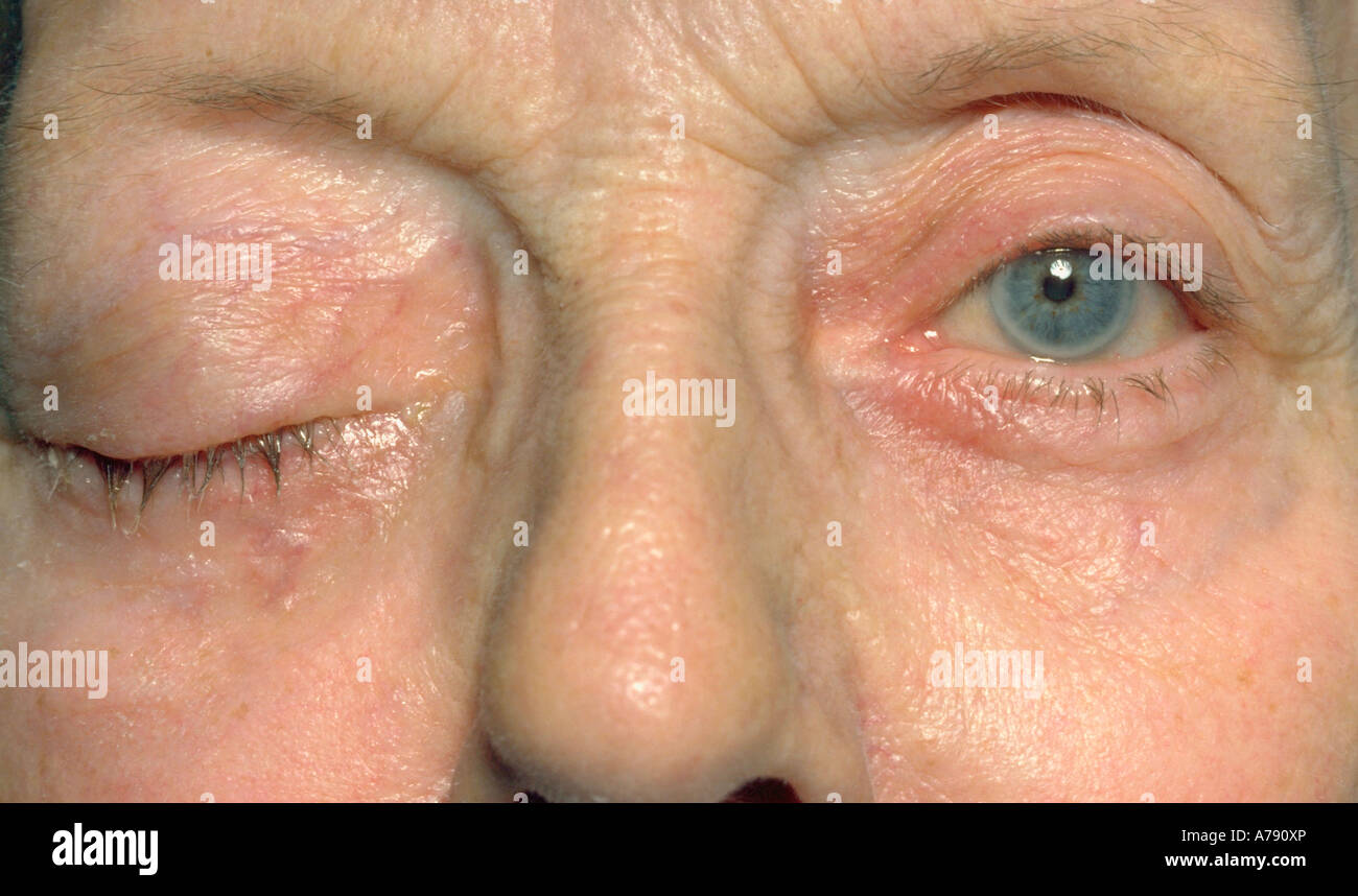 A photograph of a female with Horner's syndrome Stock Photo - Alamy