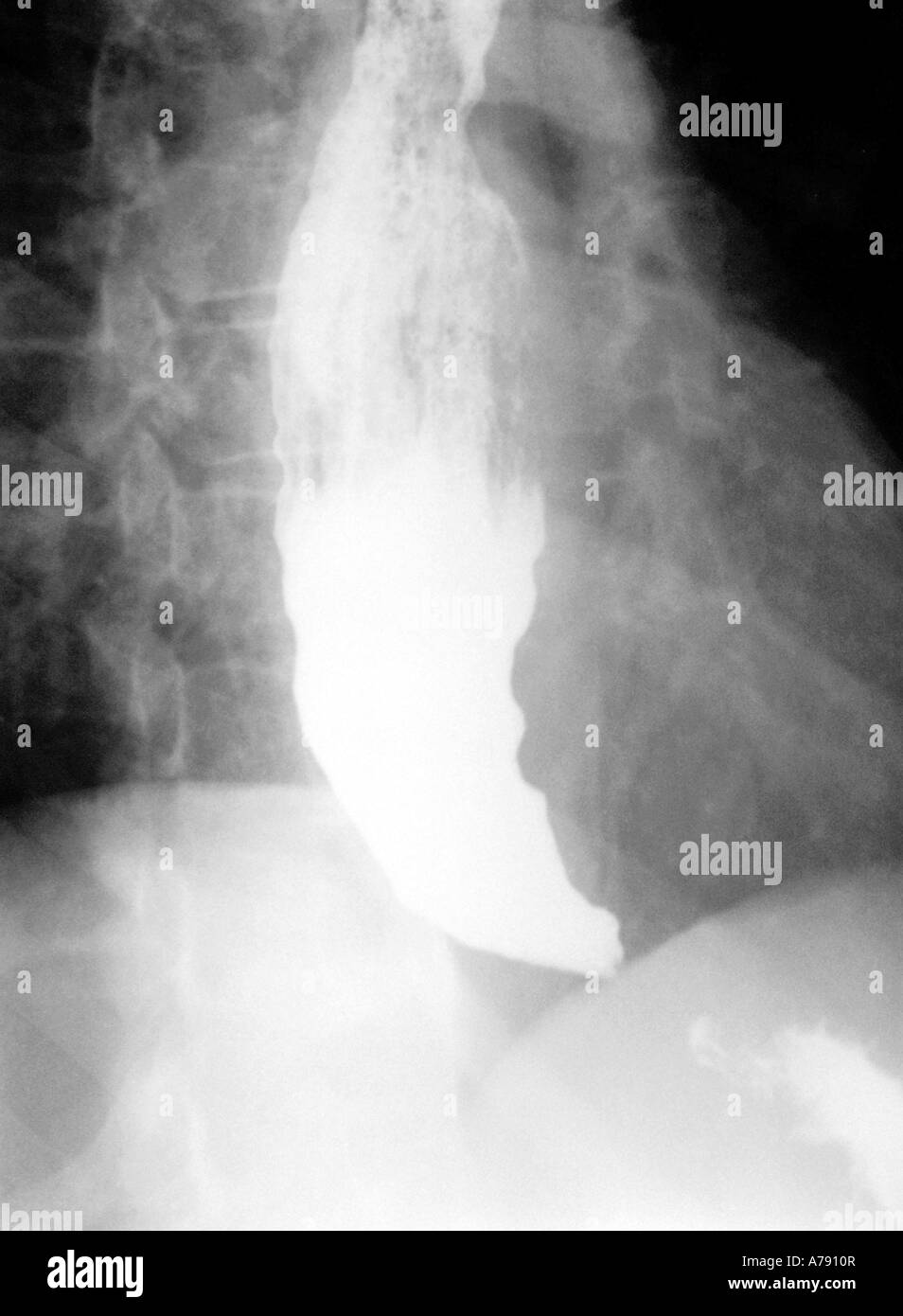 X Ray Barium Side Effects