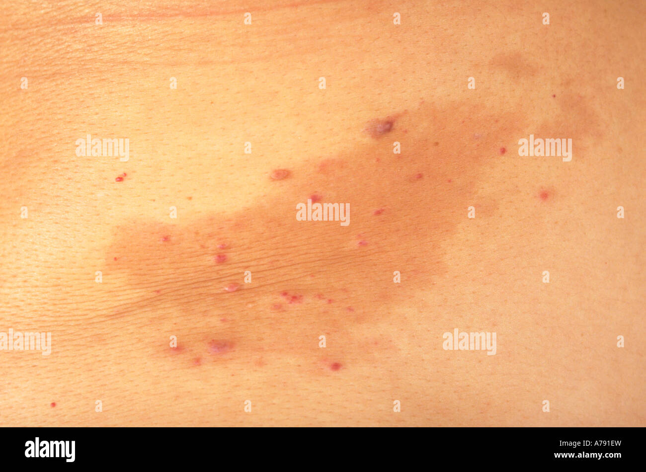 Circumscribed scleroderma hi-res stock photography and images - Alamy