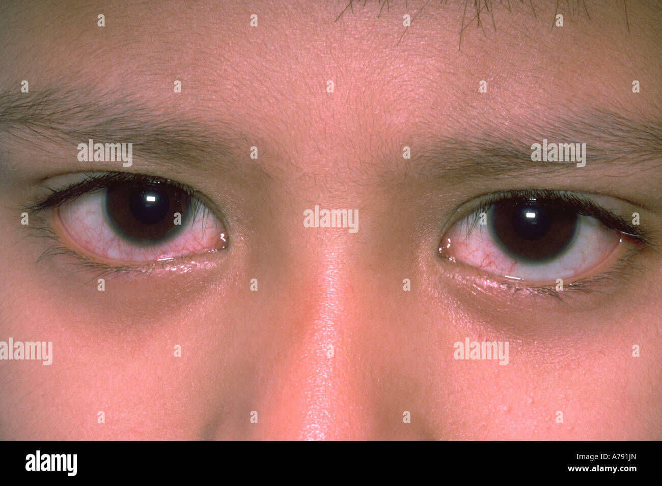Child with conjunctivitis Stock Photo - Alamy