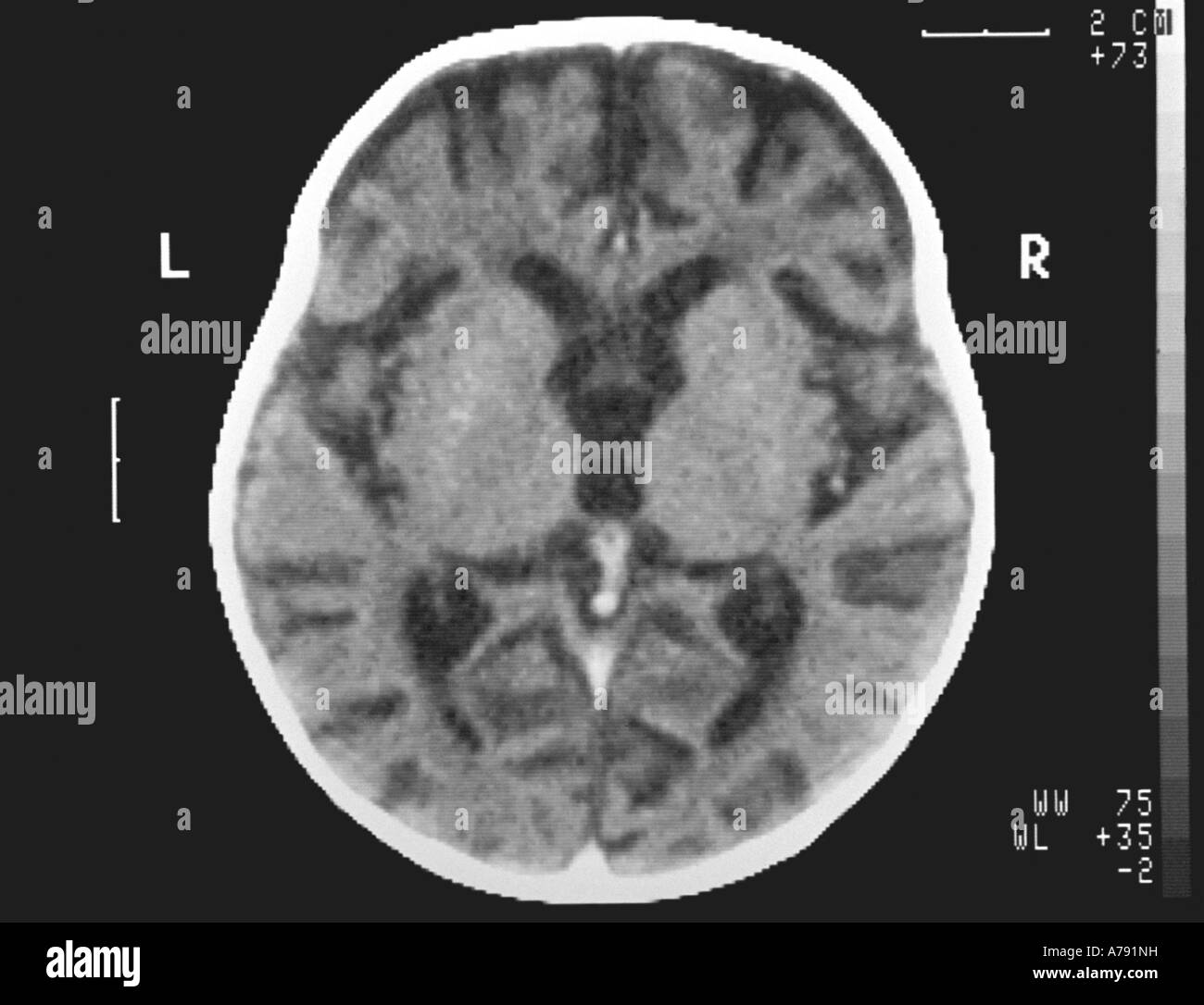 CT scan showing HIV encephalopathy Stock Photo - Alamy