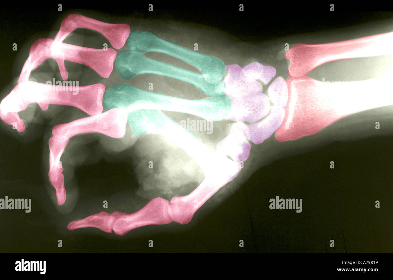 Coloured x ray of the hand Stock Photo - Alamy