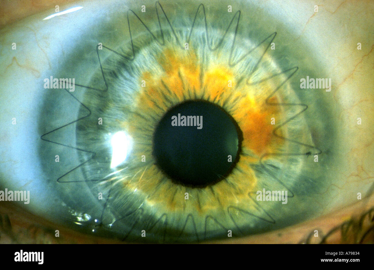 Cornea transplant hi-res stock photography and images - Alamy