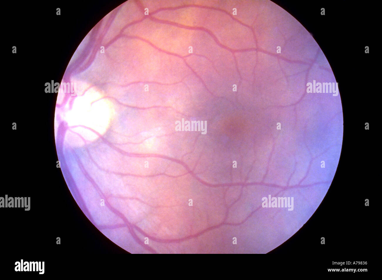 Normal retina hi-res stock photography and images - Alamy