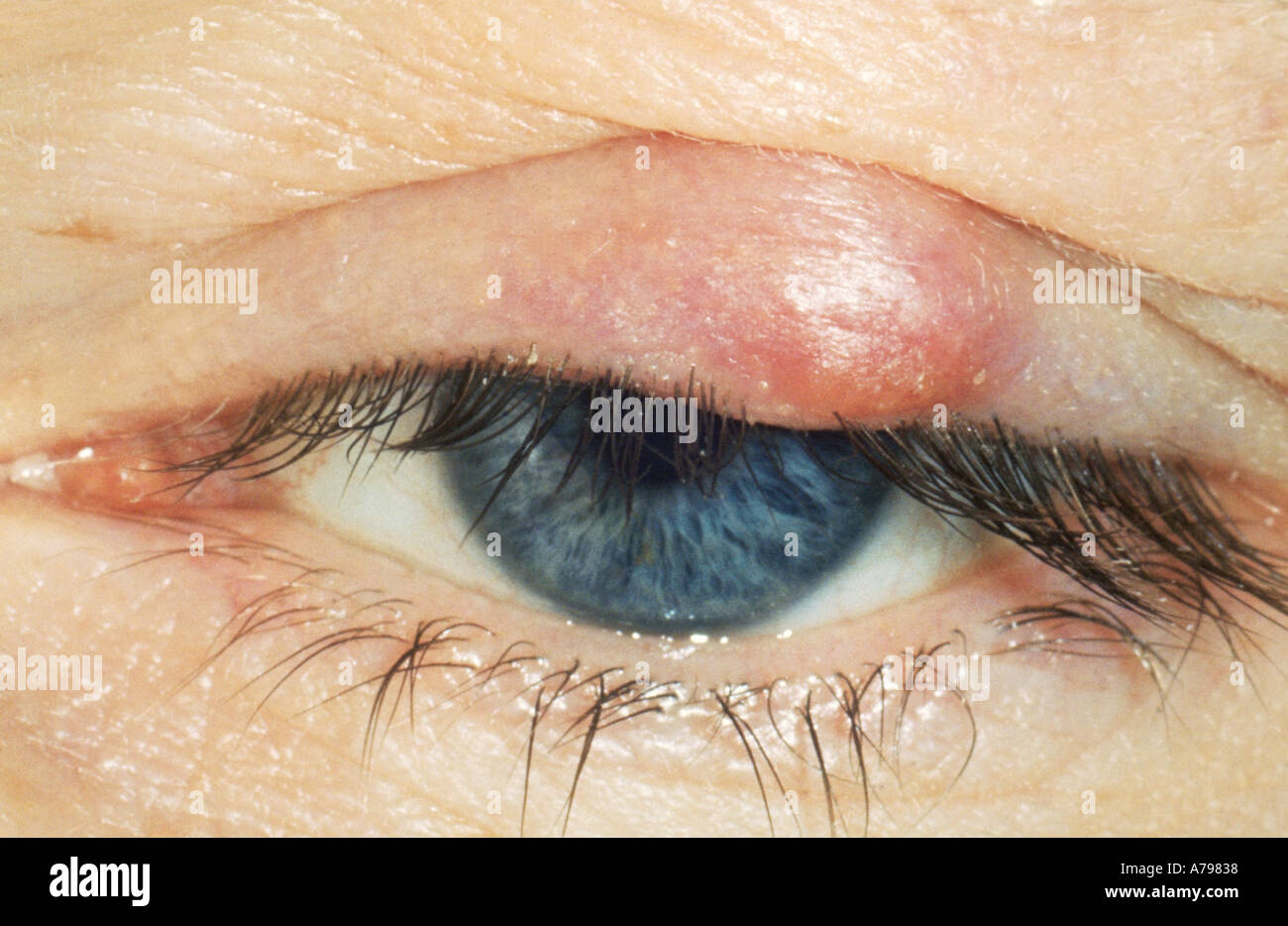 Staphylococcal infection hi-res stock photography and images - Alamy