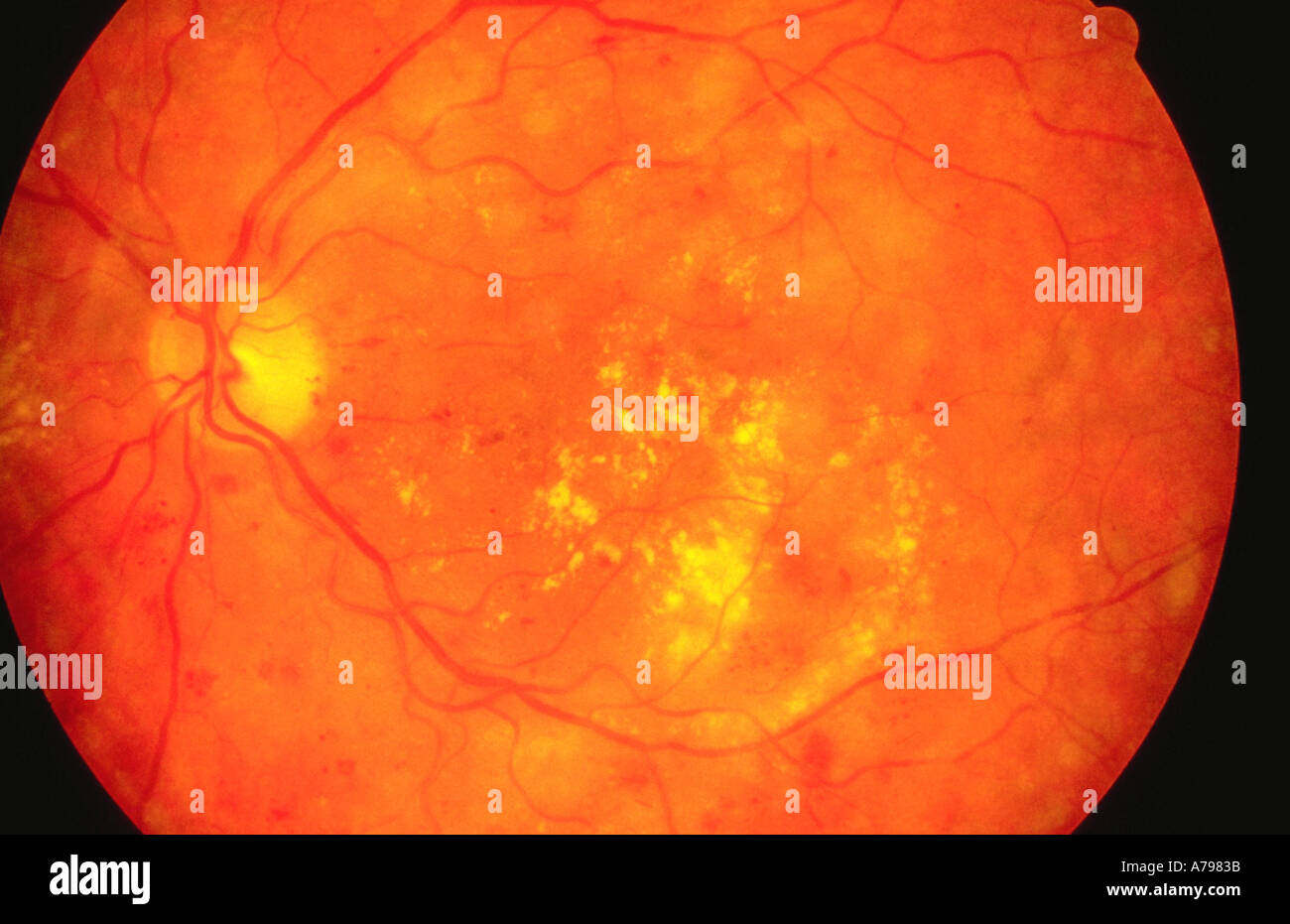 Diabetic retinopathy hemorrhage hi-res stock photography and images - Alamy
