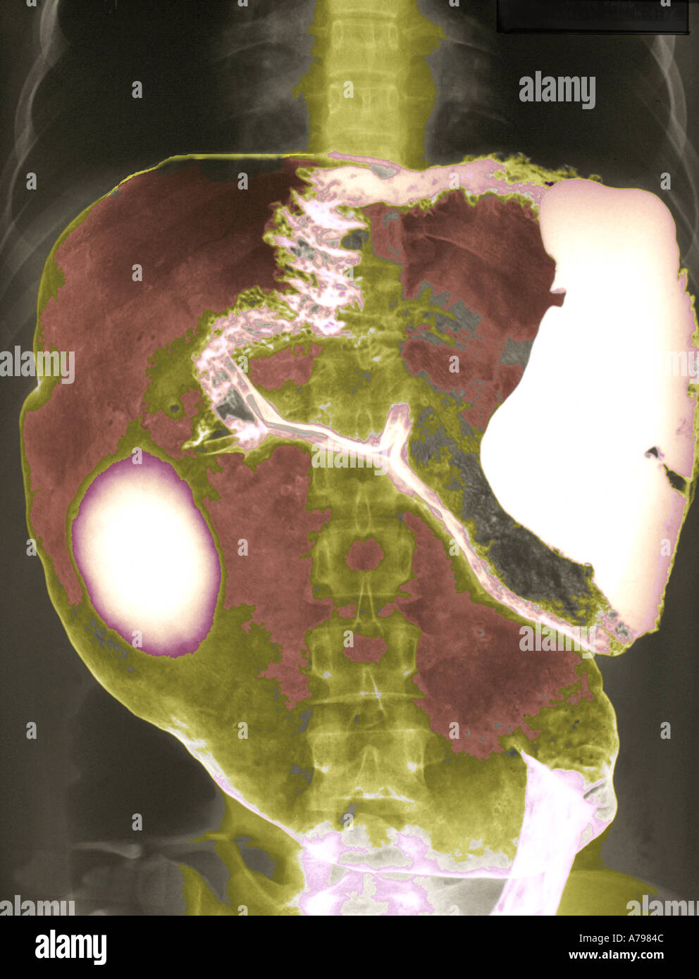 Barium meal hi-res stock photography and images - Alamy