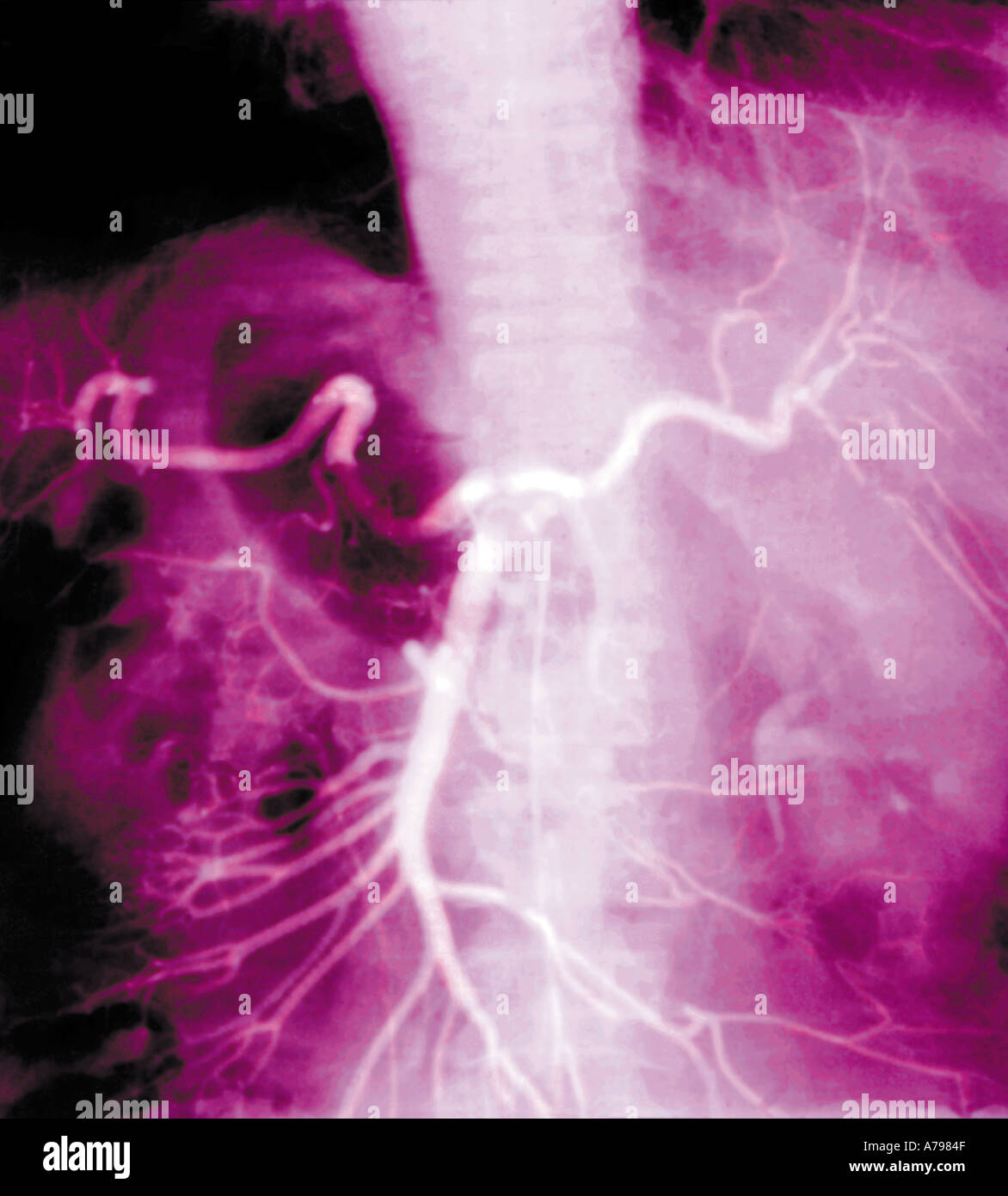 Coloured x ray showing PANCREATIC CALCIFICATION Stock Photo - Alamy