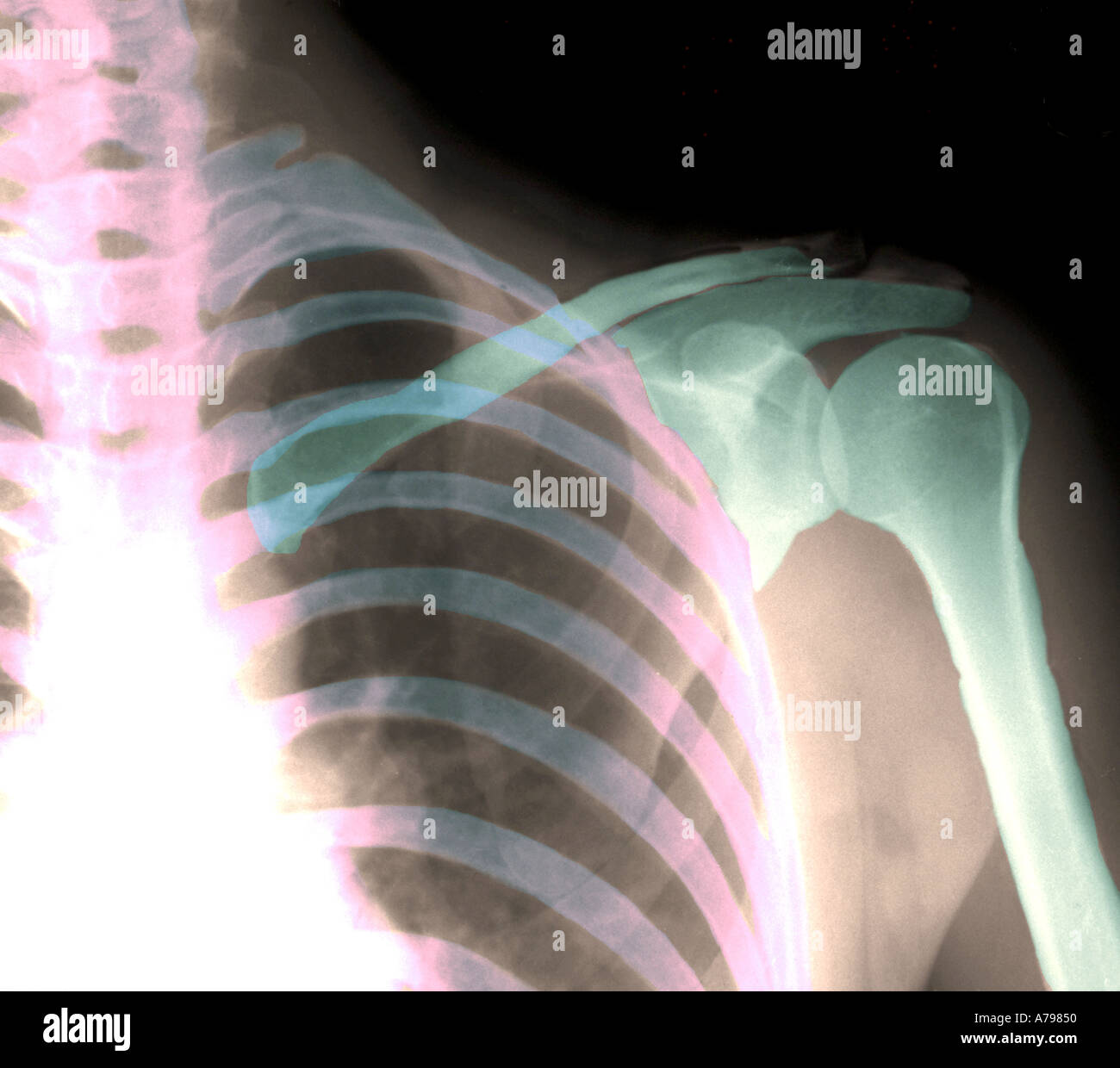 Rib Fracture High Resolution Stock Photography and Images - Alamy