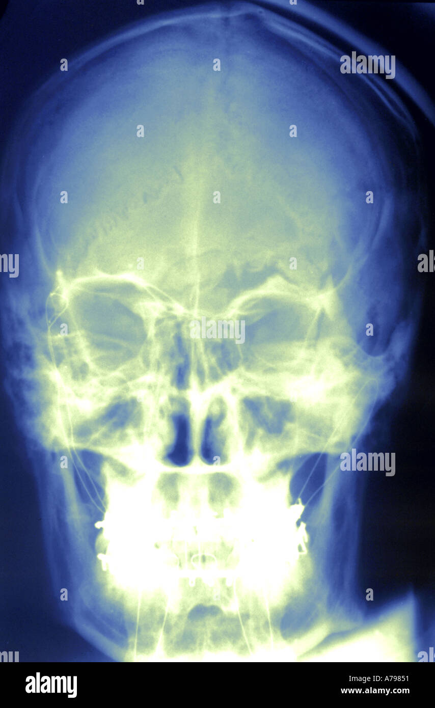 Coloured x ray of the skull Stock Photo - Alamy