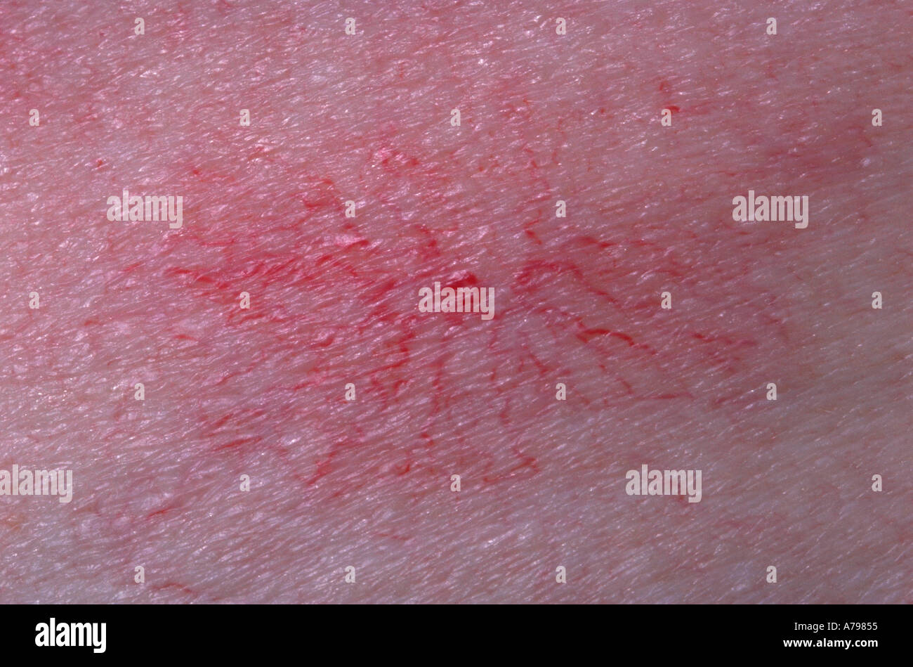 Skin angiomas hi-res stock photography and images - Alamy