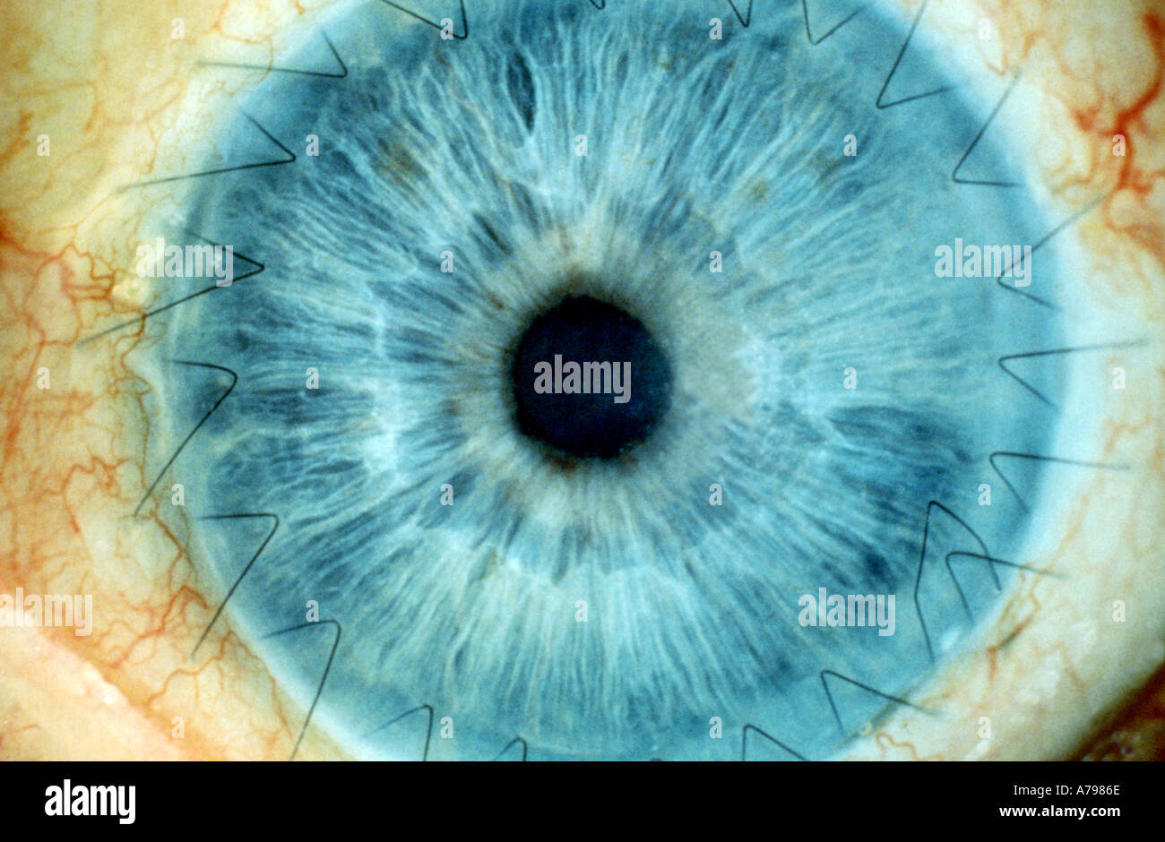 Cornea Transplant High Resolution Stock Photography and Images - Alamy