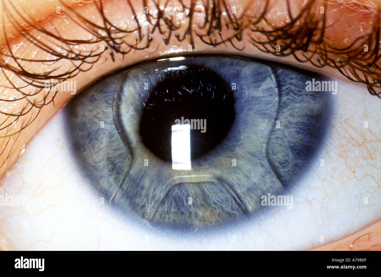 Prosthetic intraocular lenses hi-res stock photography and images - Alamy