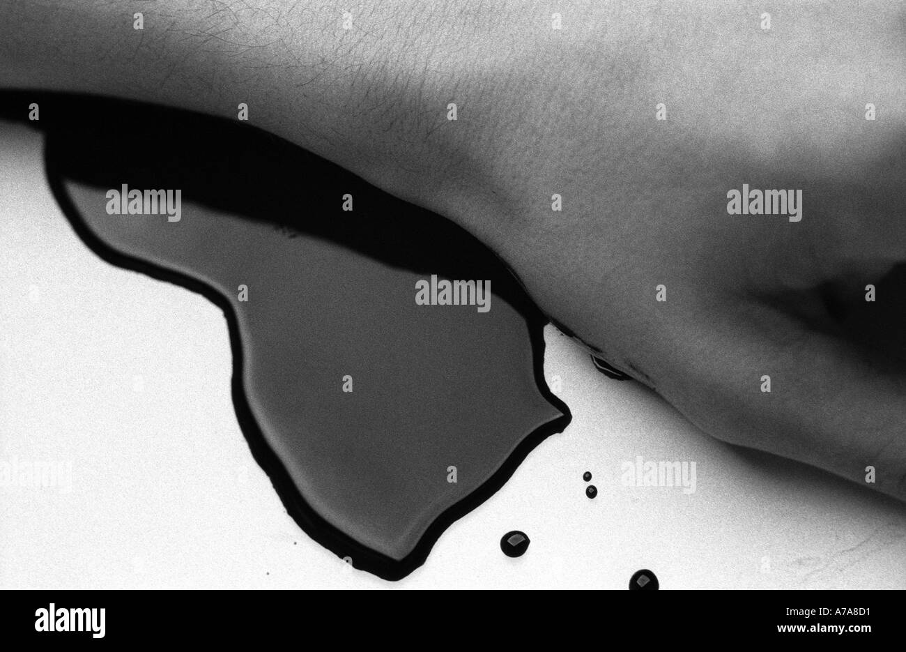 Internal Bleeding Stomach