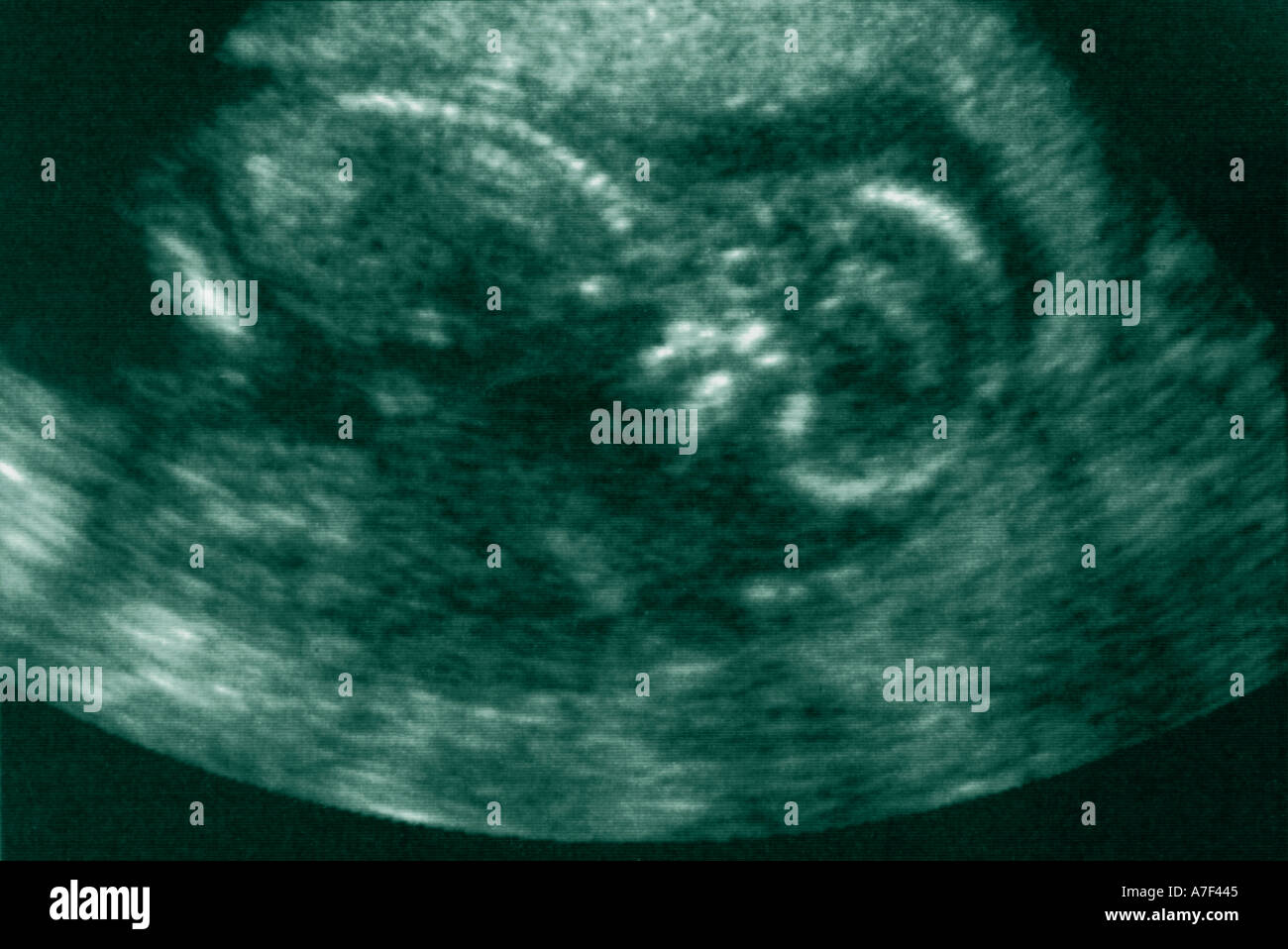 Medical radiology ultrasound image showing a fetus in a pregnant woman ...