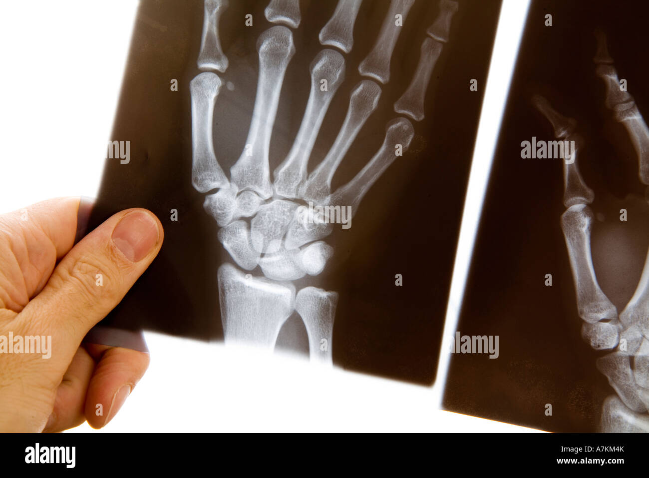 Broken thumb x ray hi-res stock photography and images - Alamy
