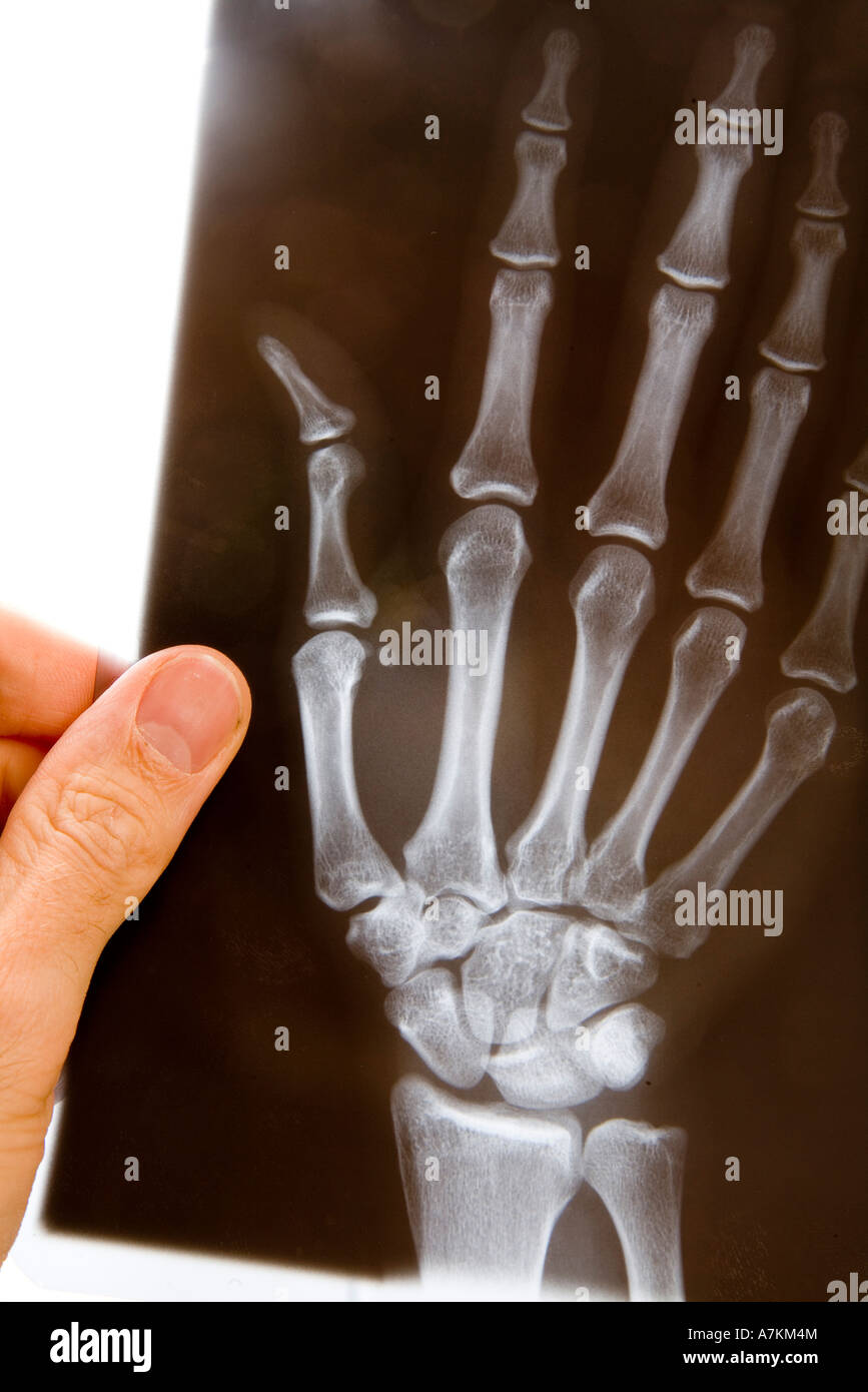 Crushed Hand X Ray