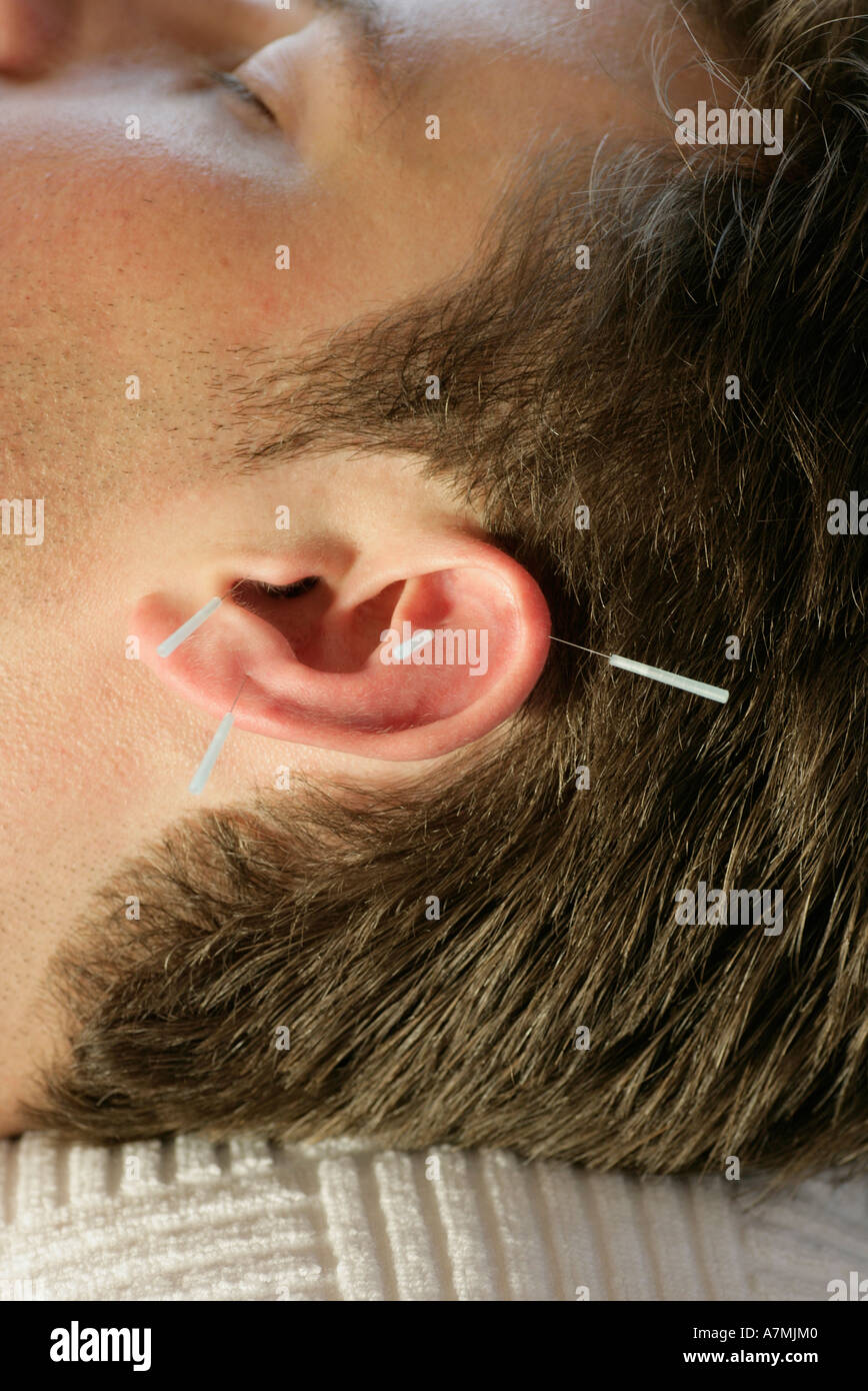 Acupuncture ear hi-res stock photography and images - Alamy