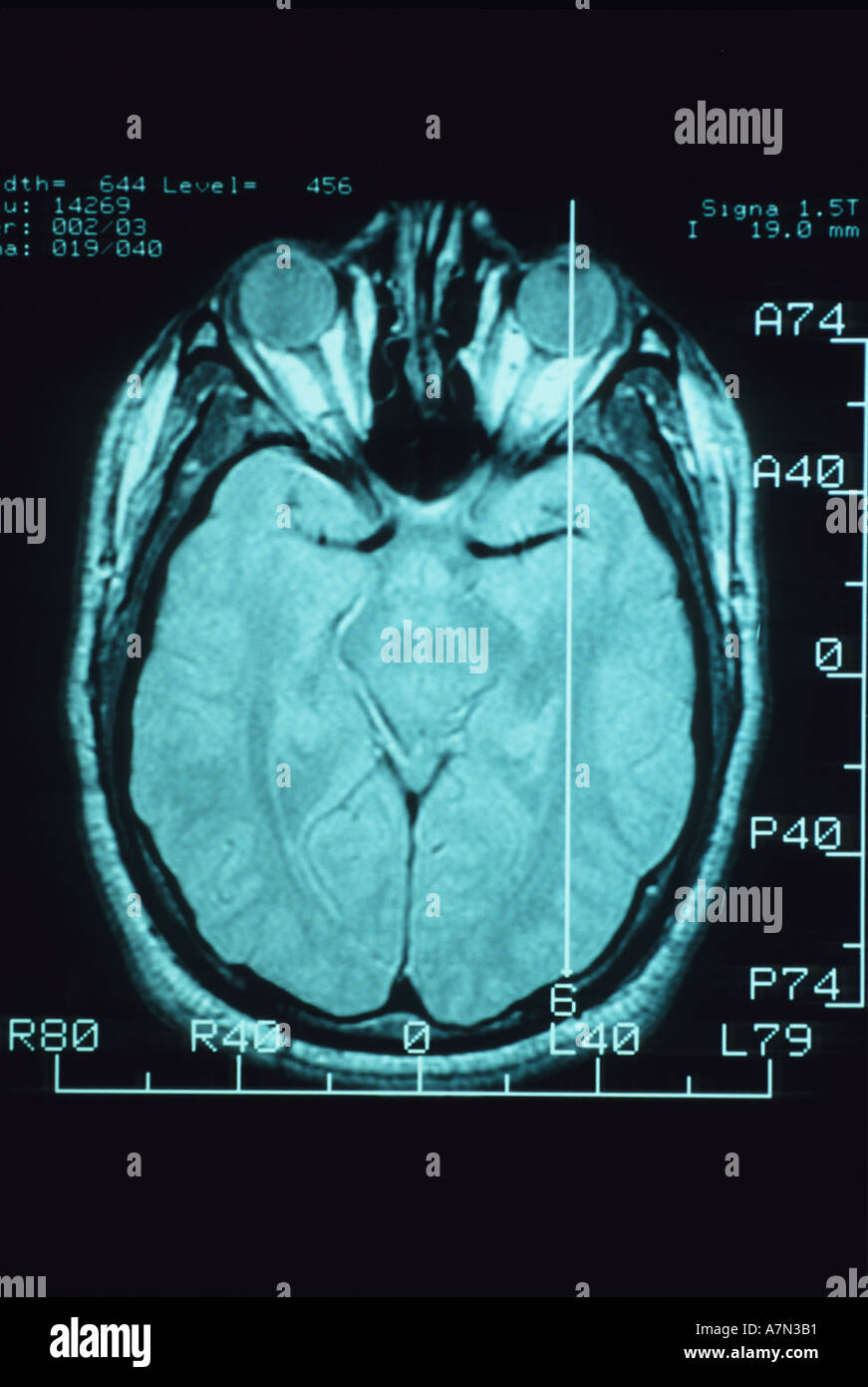 An MRI image showing bone and tissue of human head Stock Photo - Alamy