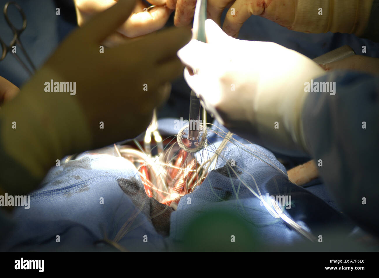 Herzoperation hi-res stock photography and images - Alamy