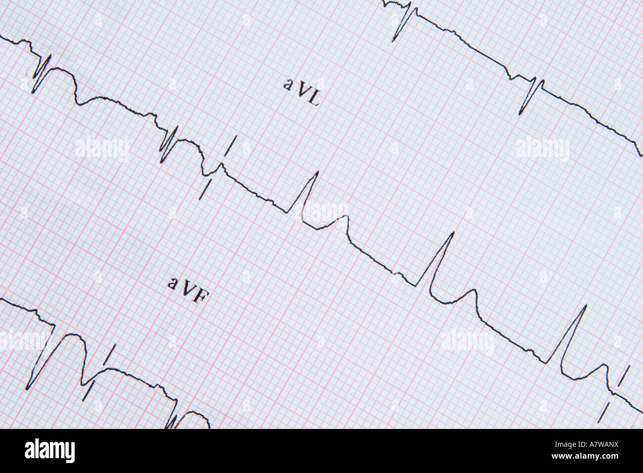 Heart attack ecg hi-res stock photography and images - Alamy