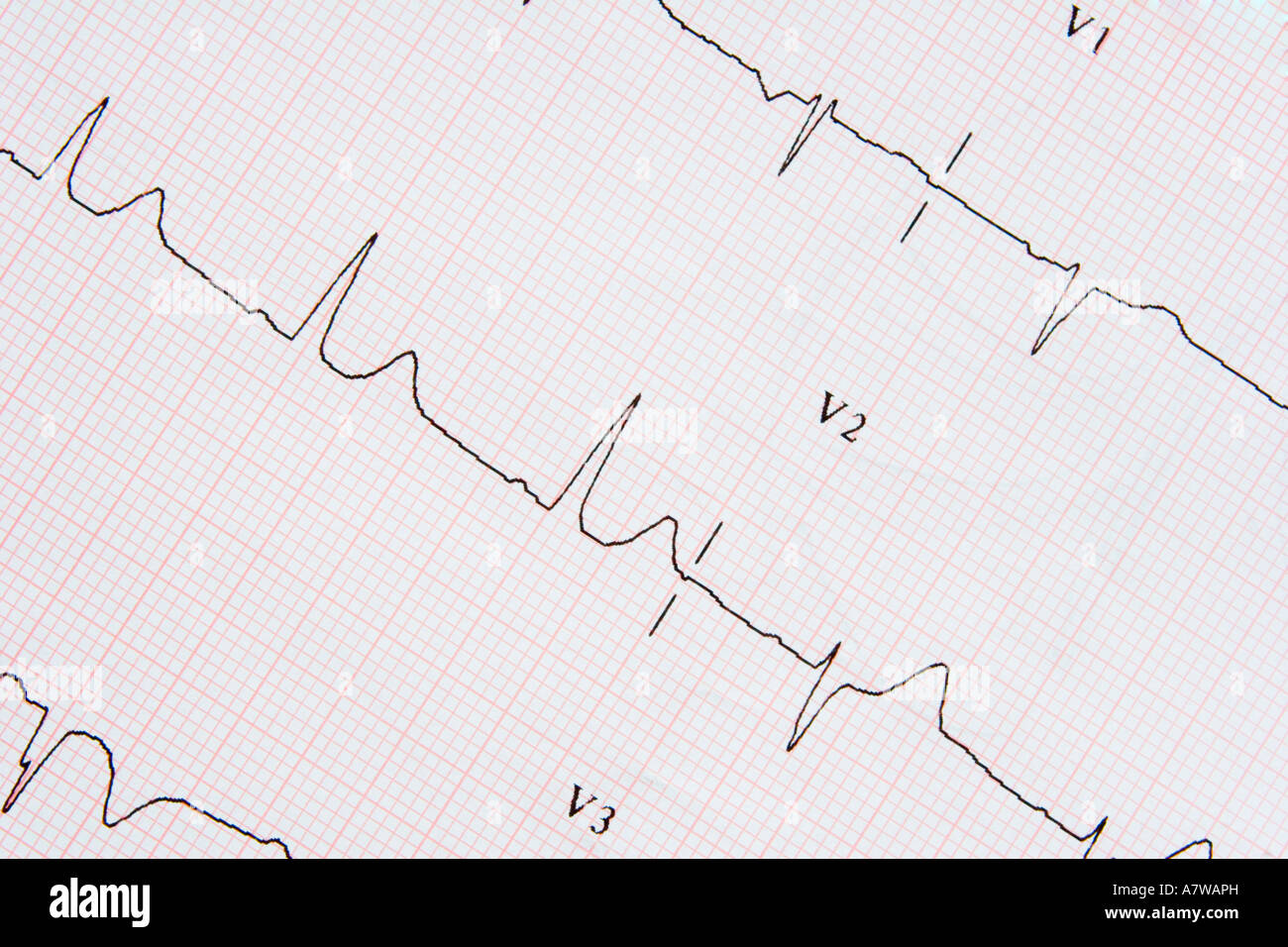 ECG trace showing post heart attack results Stock Photo - Alamy