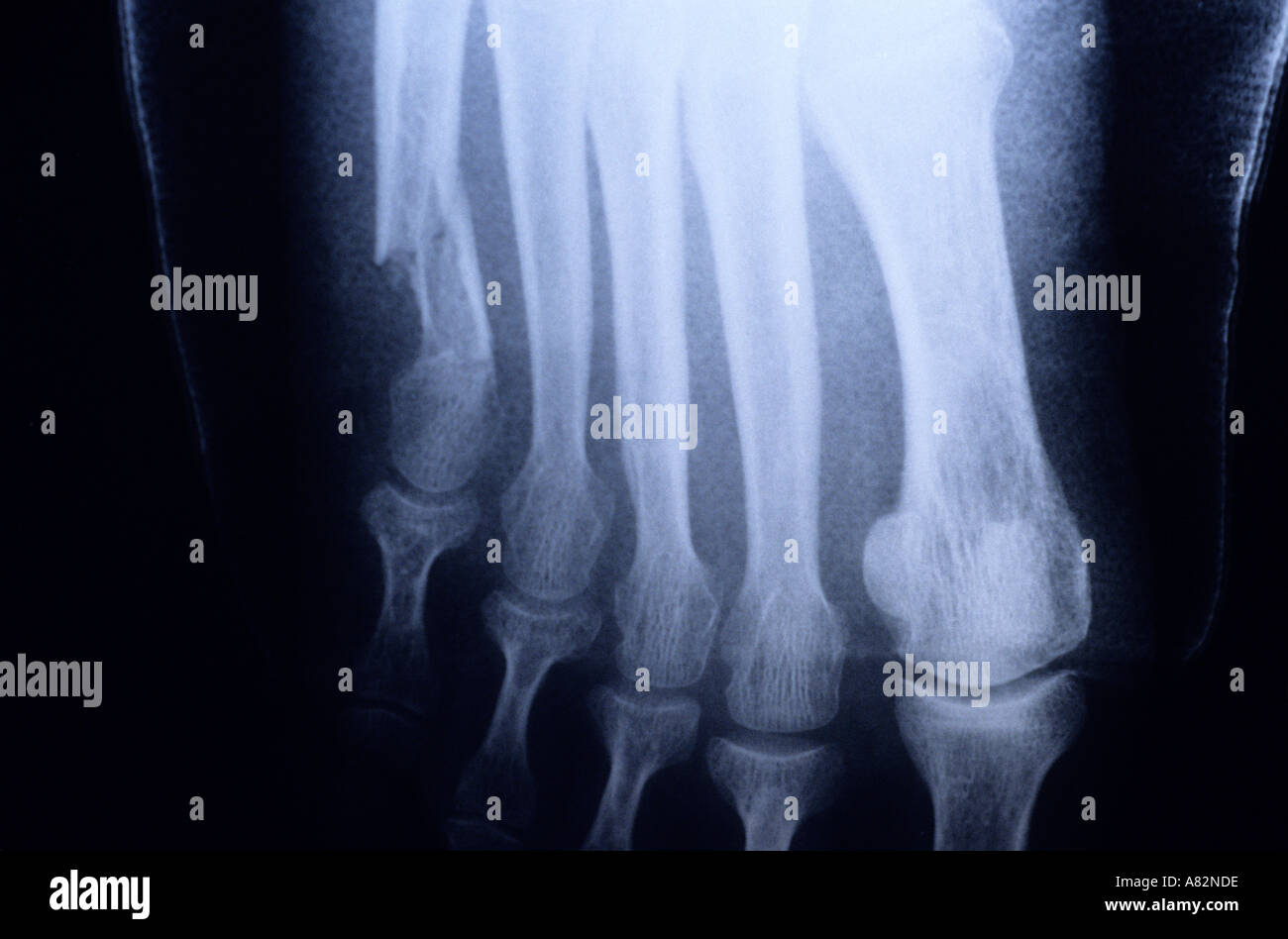 Foot break bone radiography Stock Photo - Alamy