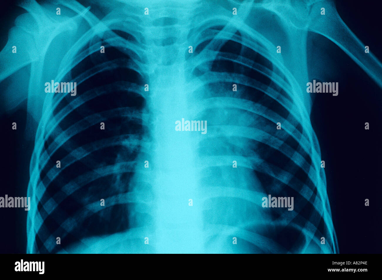 Girl chest radiography Stock Photo - Alamy