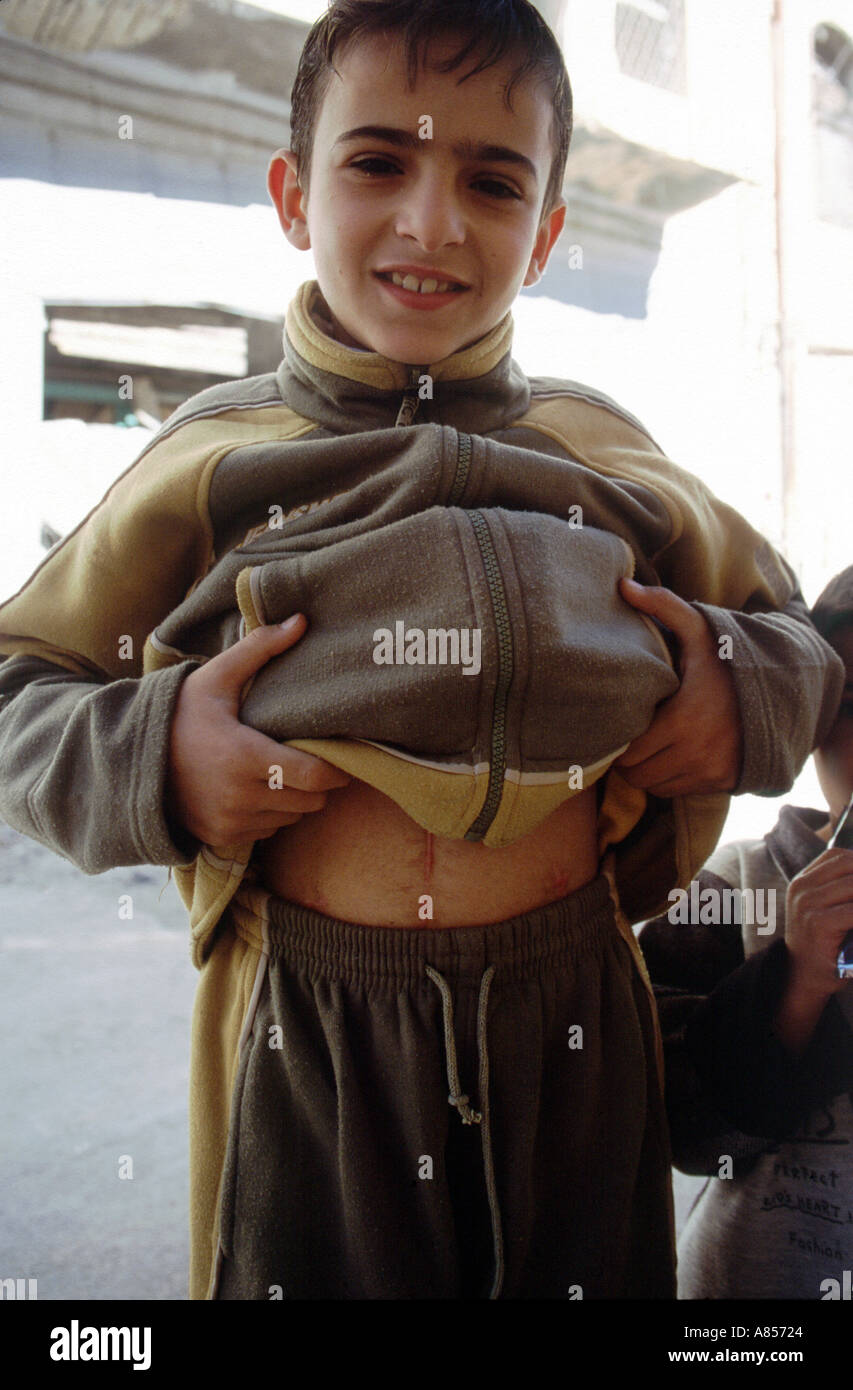 A young boy showing his scars recieved from a tank blast Nablus ...