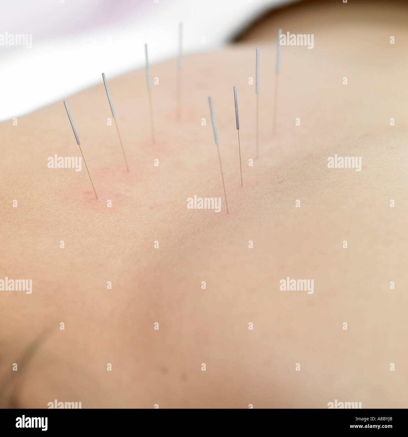 Chinese medicine oriental medicine patient's back with needles Stock ...