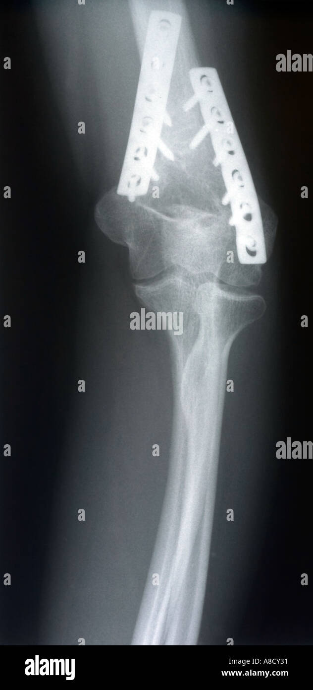 Bone fix hi-res stock photography and images - Alamy