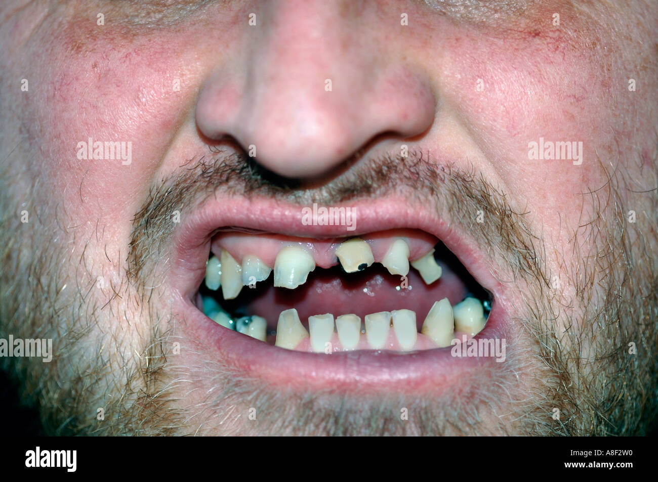 Mans Disfigured Teeth Stock Photo - Alamy