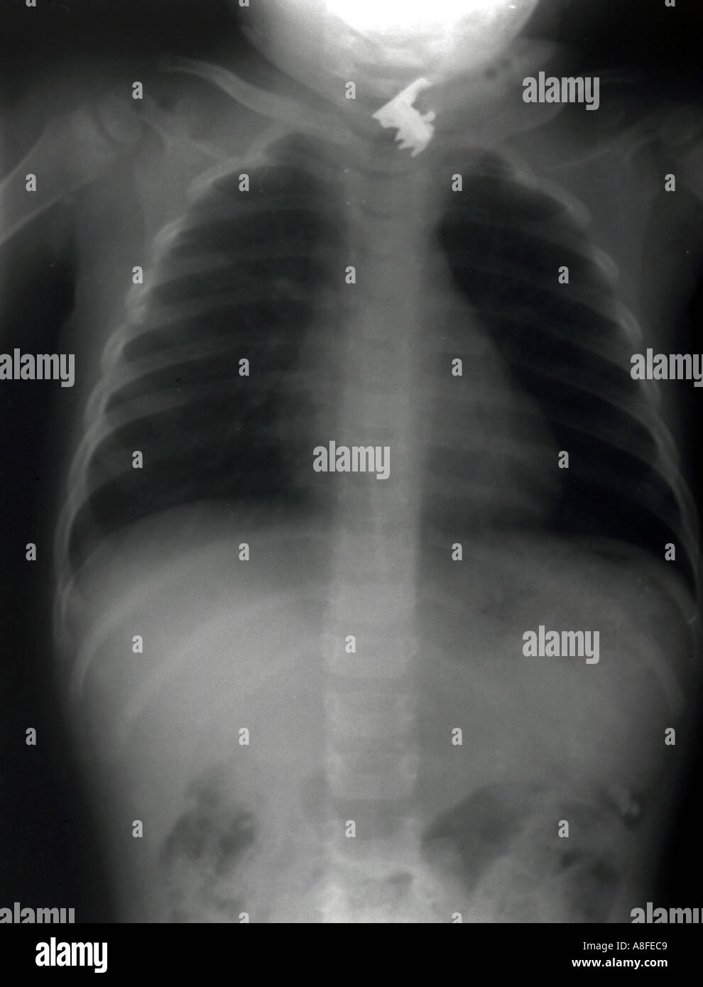 x ray metal badge in oesophagus Stock Photo - Alamy