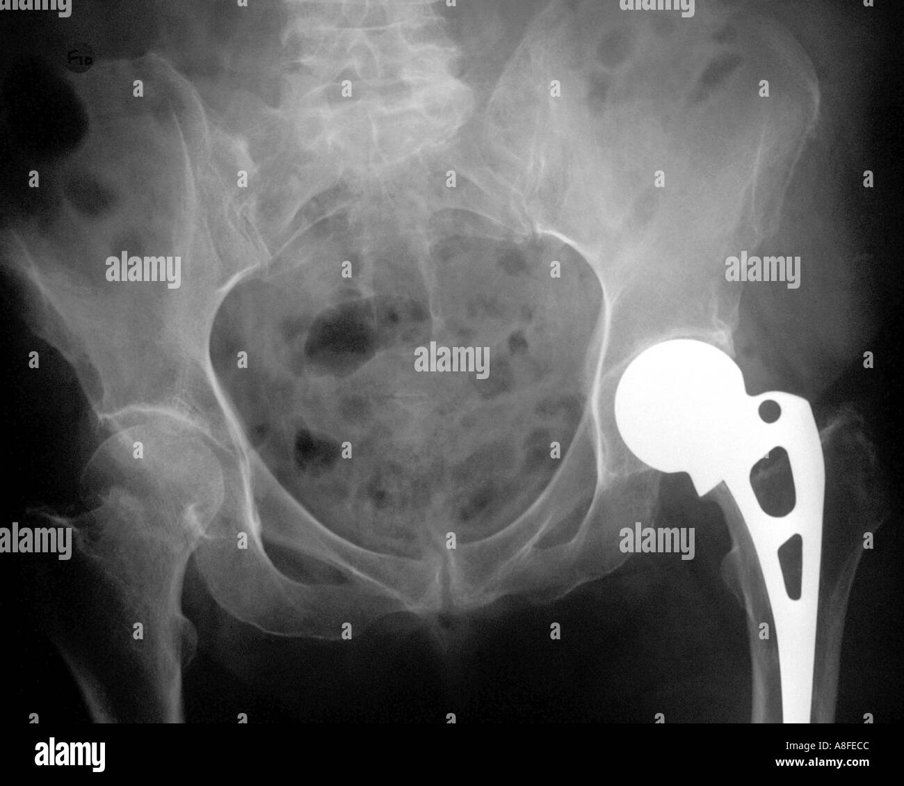 Hemiarthroplasty hi-res stock photography and images - Alamy