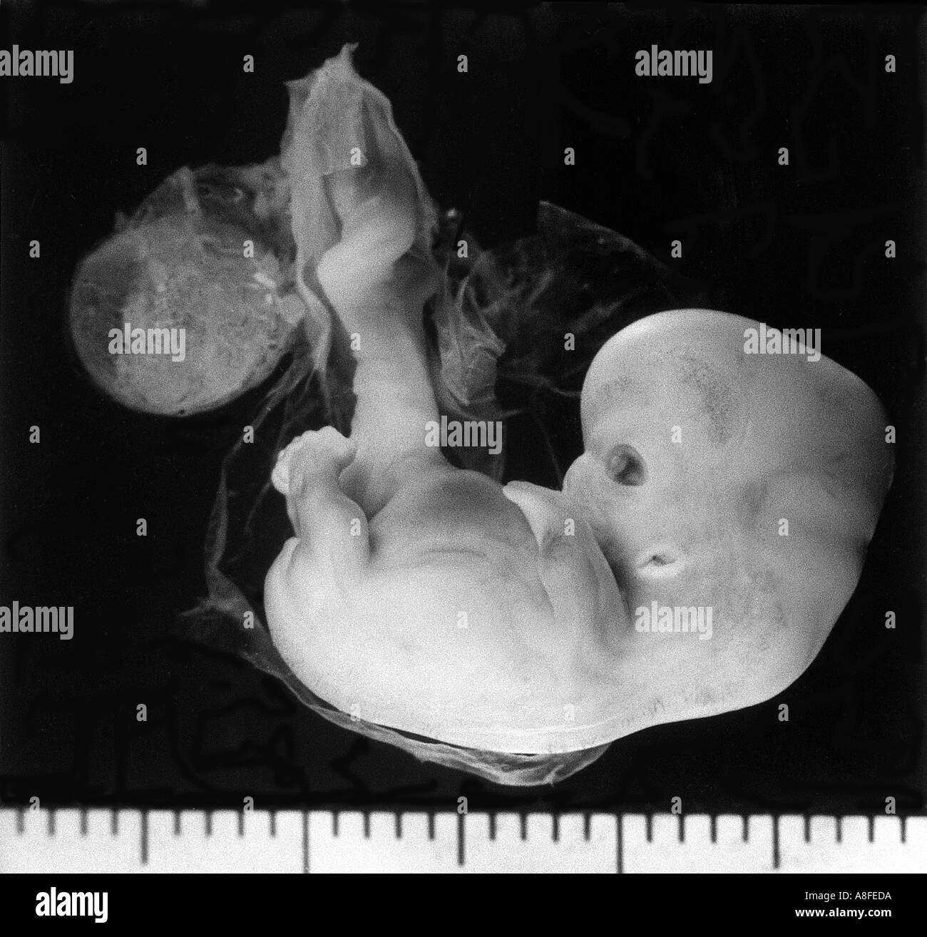 Fetal foetal Black and White Stock Photos & Images - Alamy